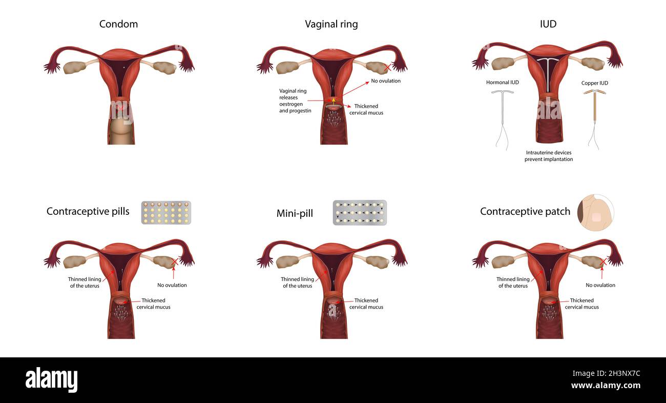 Contraception methods, illustration Stock Photo - Alamy