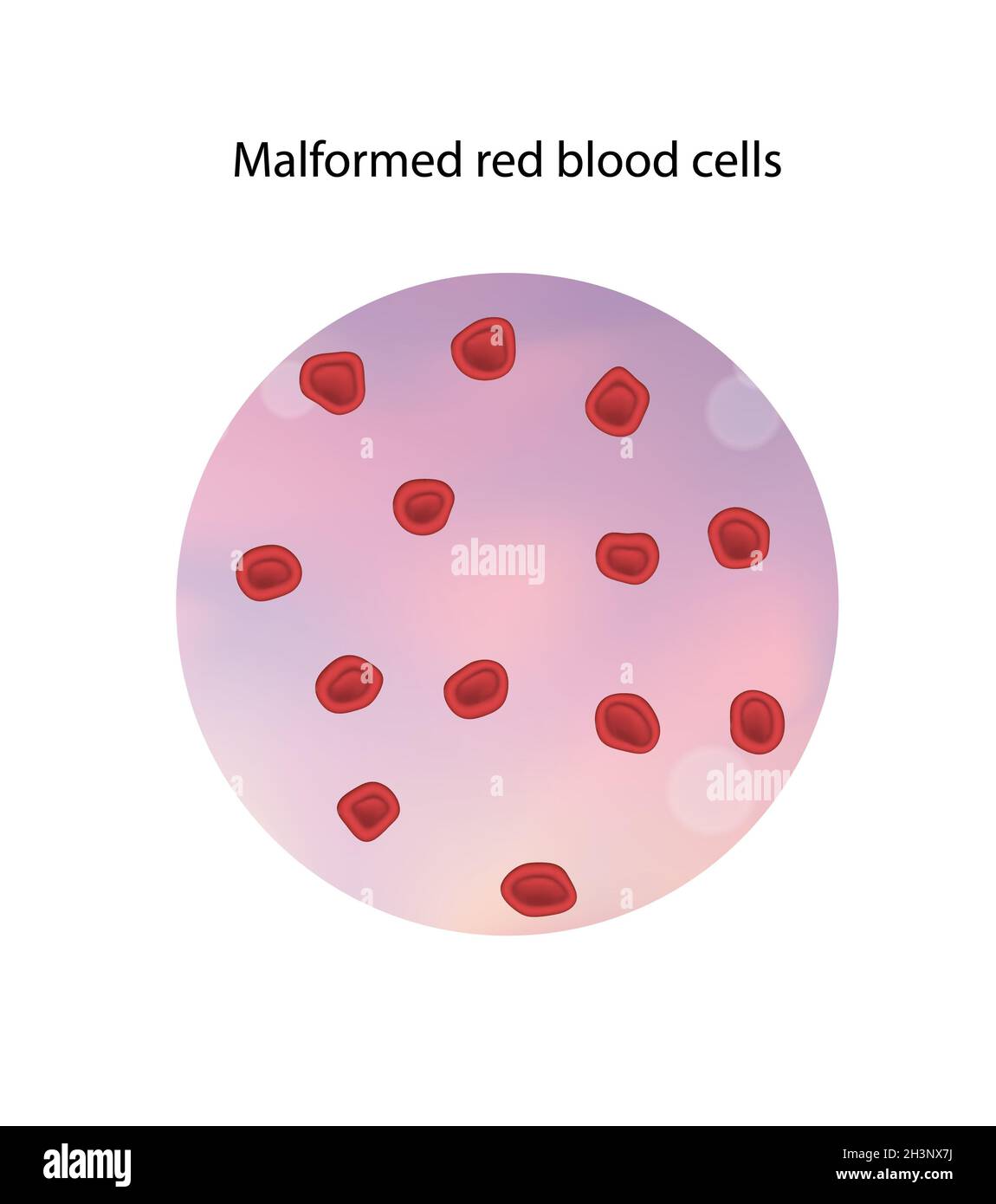 Malformed red blood cells, illustration Stock Photo - Alamy