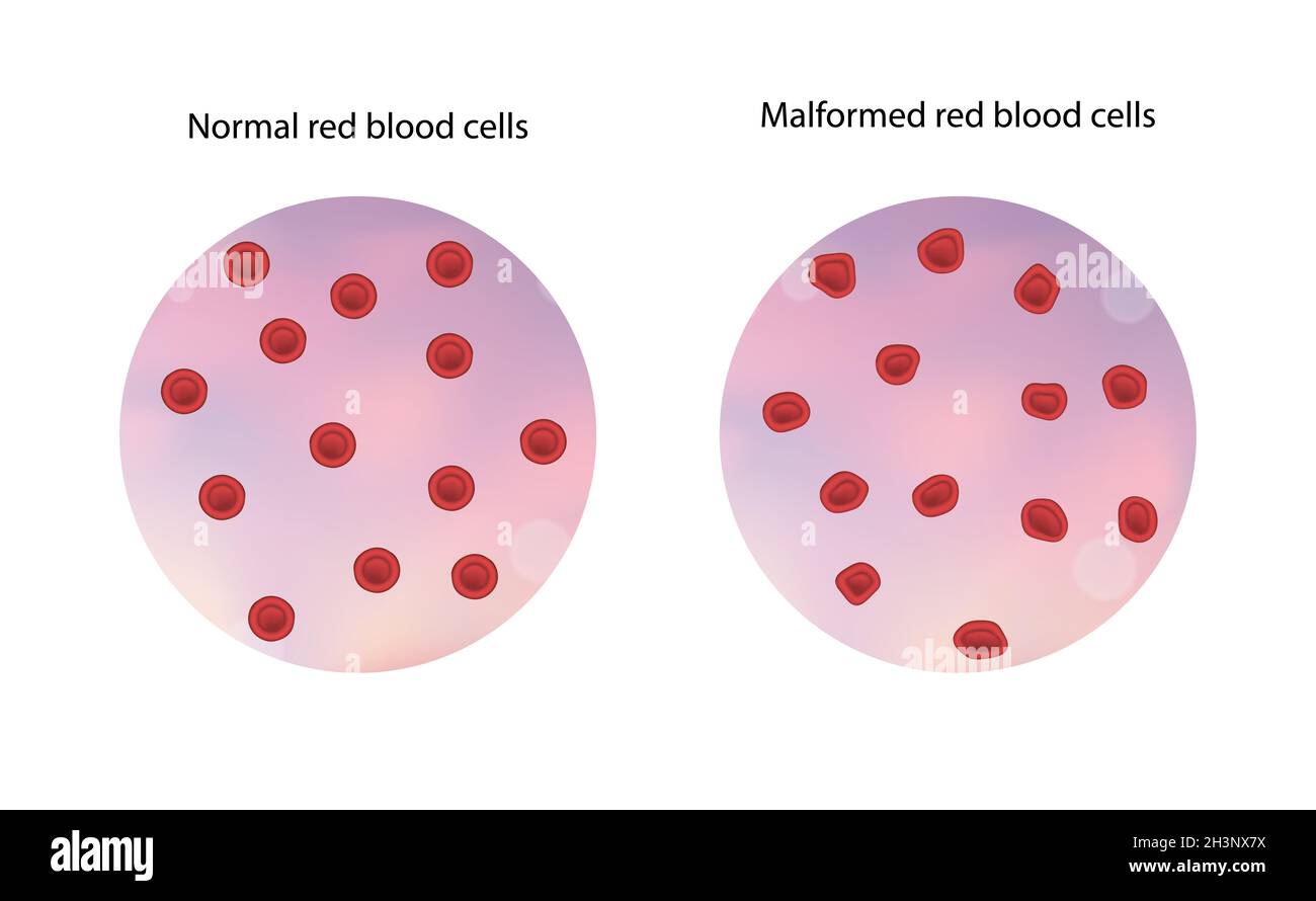 Normal and malformed red blood cells, illustration Stock Photo - Alamy