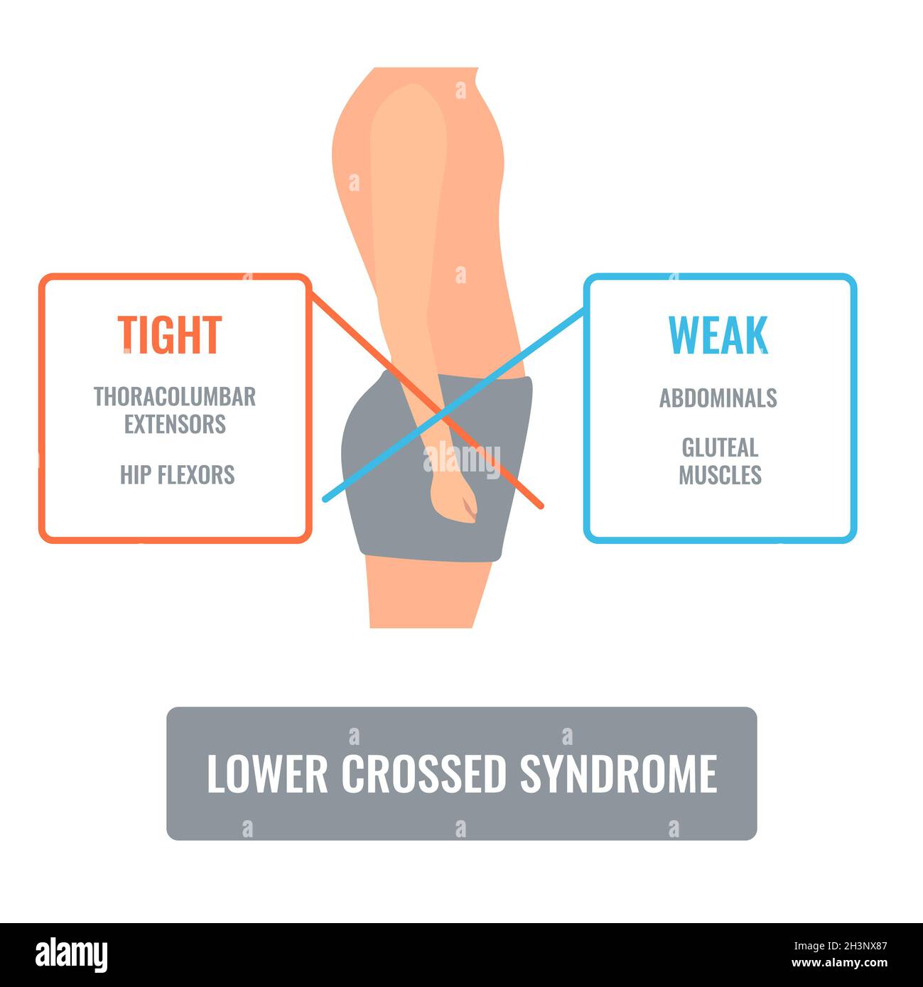 Lower crossed syndrome, conceptual illustration Stock Photo - Alamy