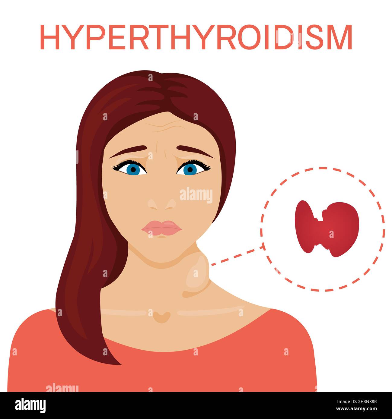 Hyperthyroidism In Children