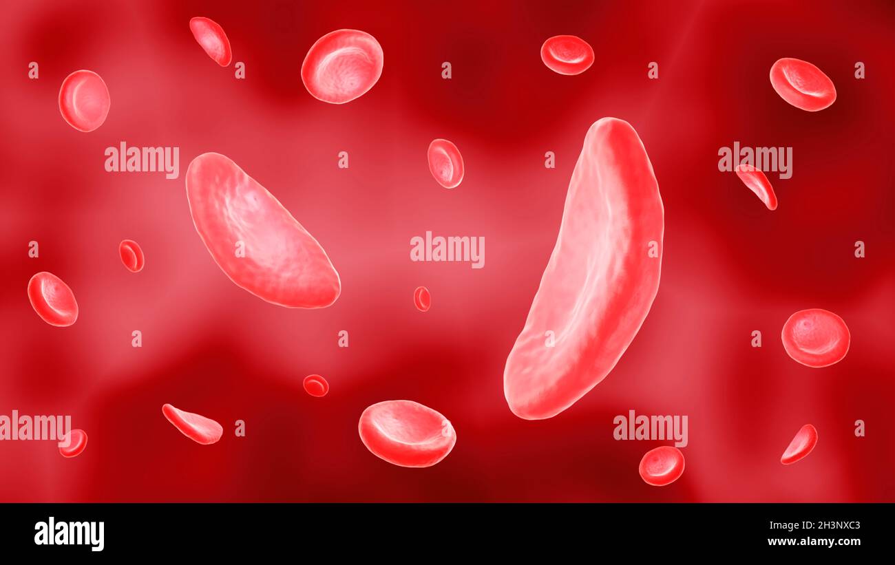 Sickle cell disease hi-res stock photography and images - Alamy