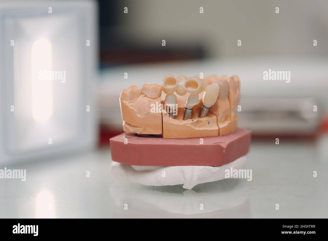 Dental layout of the human jaw with teeth and implants Stock Photo - Alamy