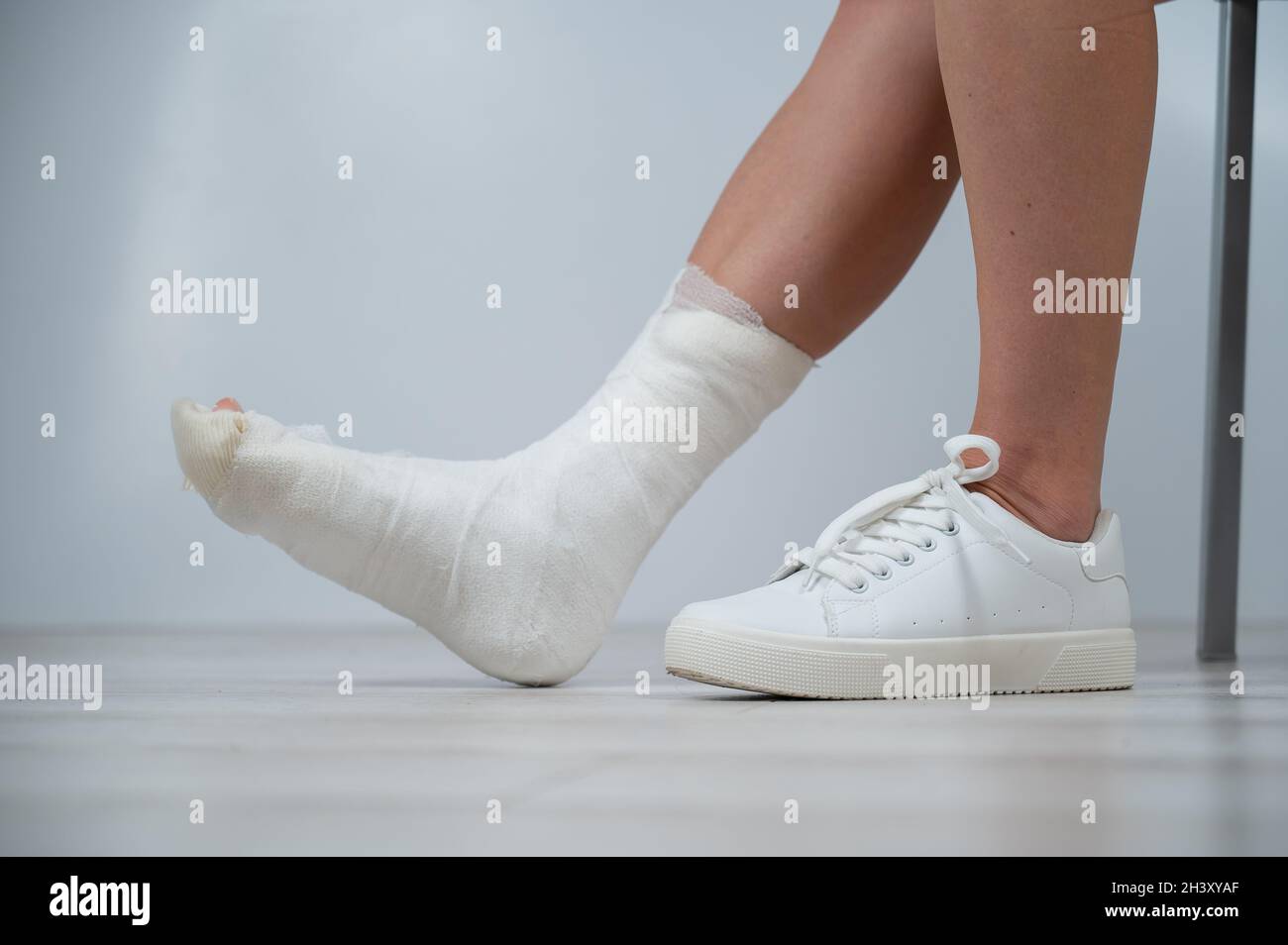 Close-up of female legs with plaster cast. A woman with a broken leg ...