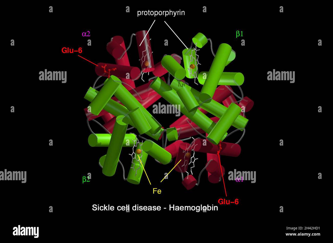 Sickle cell disease - mol. model haemoglobin Stock Photo - Alamy