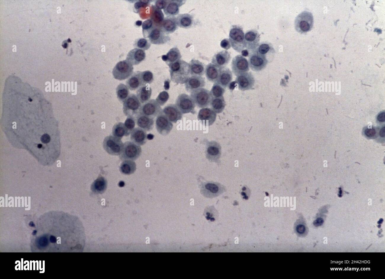 Histiocytes hi-res stock photography and images - Alamy