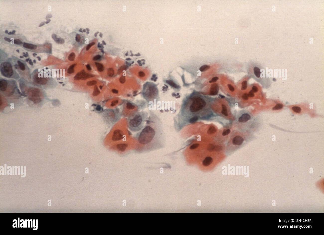 Wart virus infection Stock Photo - Alamy