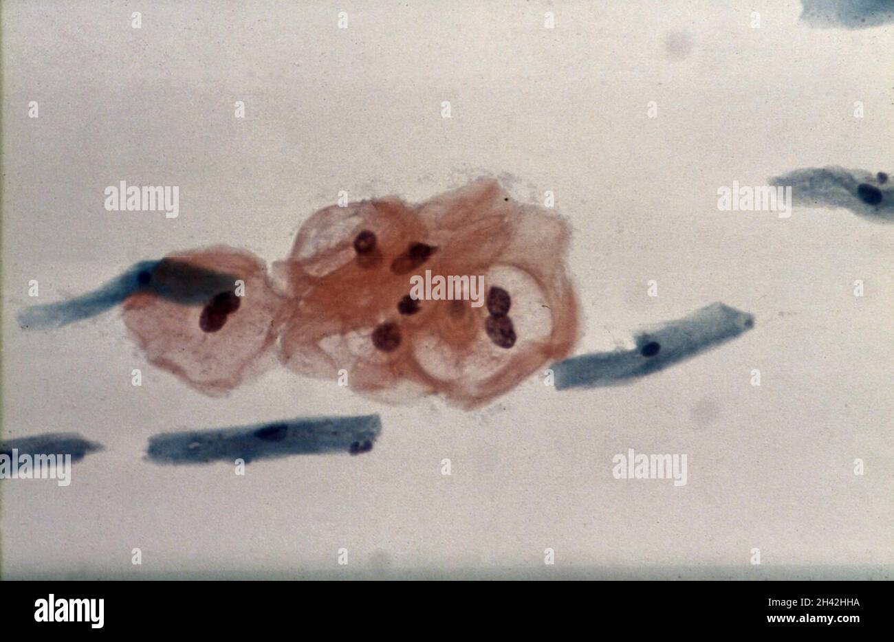 Infectious disease human papilloma hi-res stock photography and images ...
