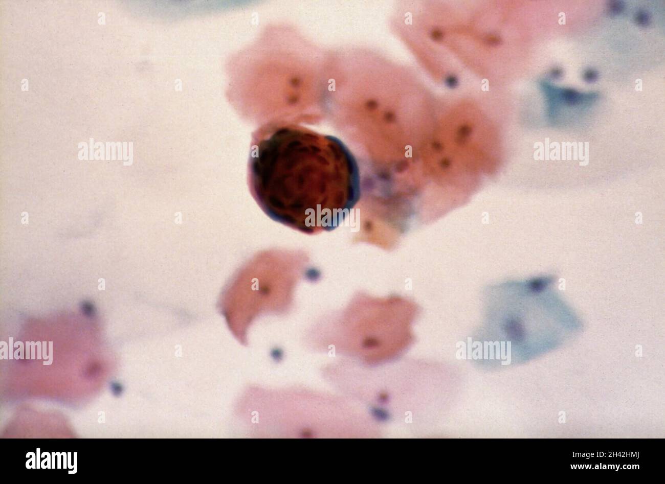 Gingival Epithelial Pearls