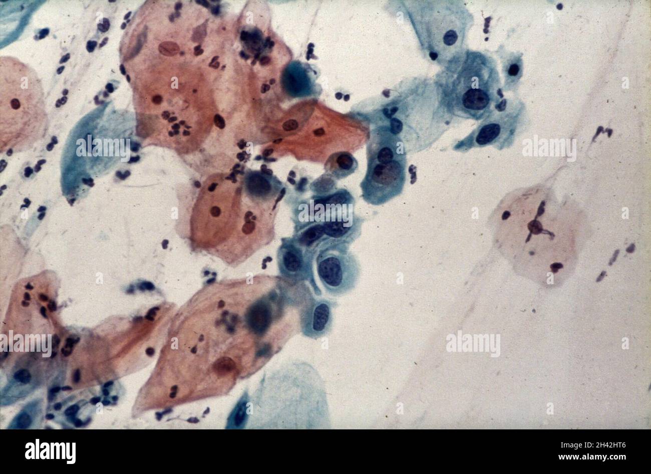 Pre cancerous cells hi-res stock photography and images - Alamy