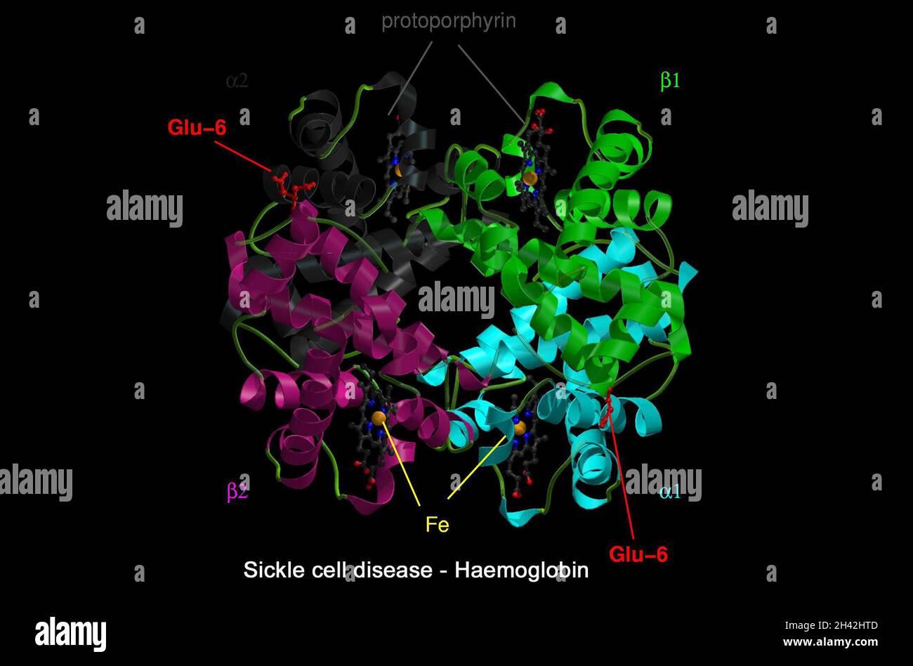 Sickle cell disease - mol. model haemoglobin Stock Photo - Alamy