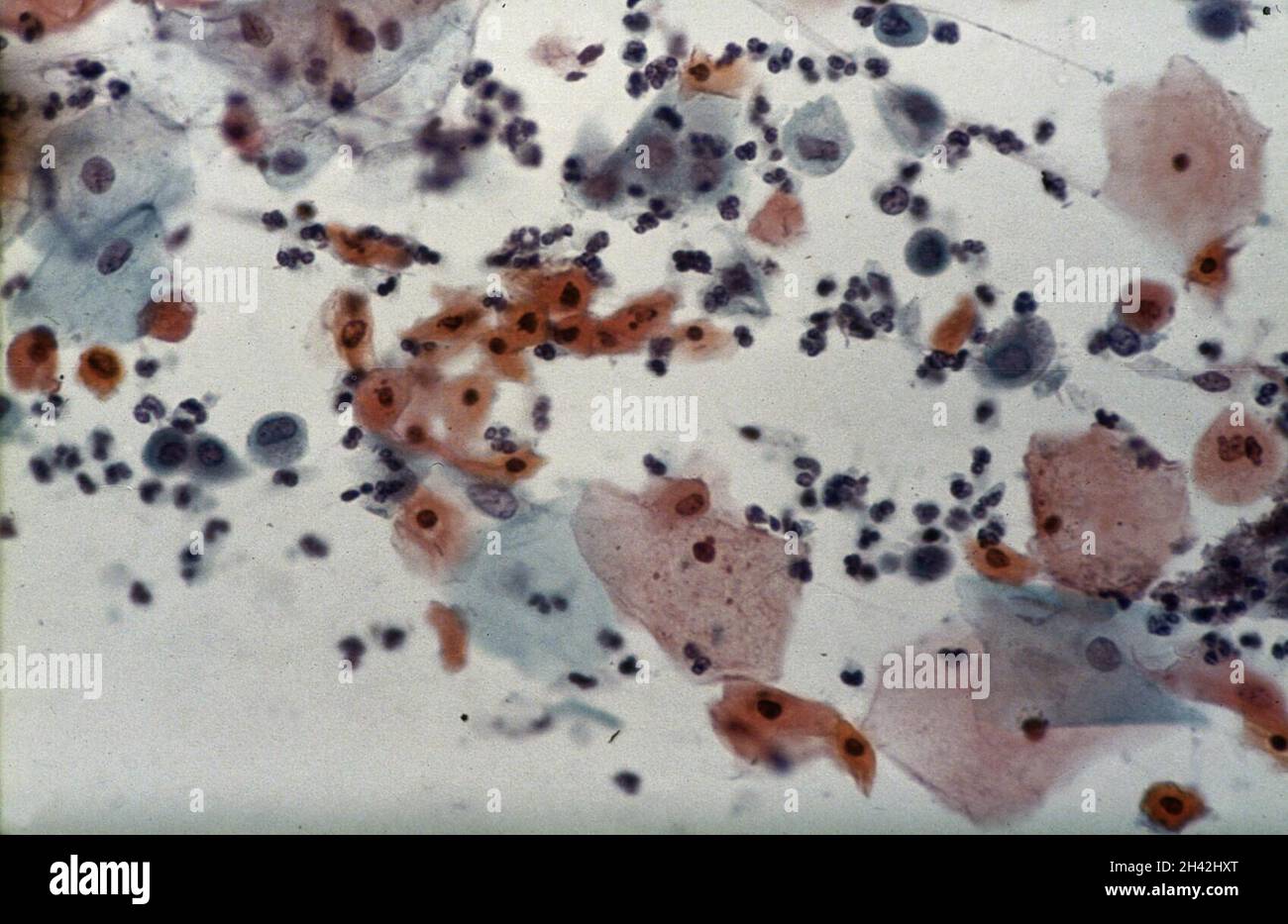 Viral wart hi-res stock photography and images - Alamy