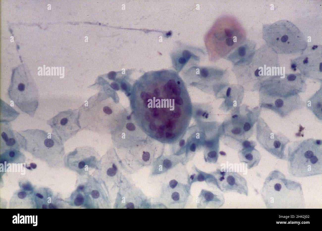 Histiocytes hi-res stock photography and images - Alamy