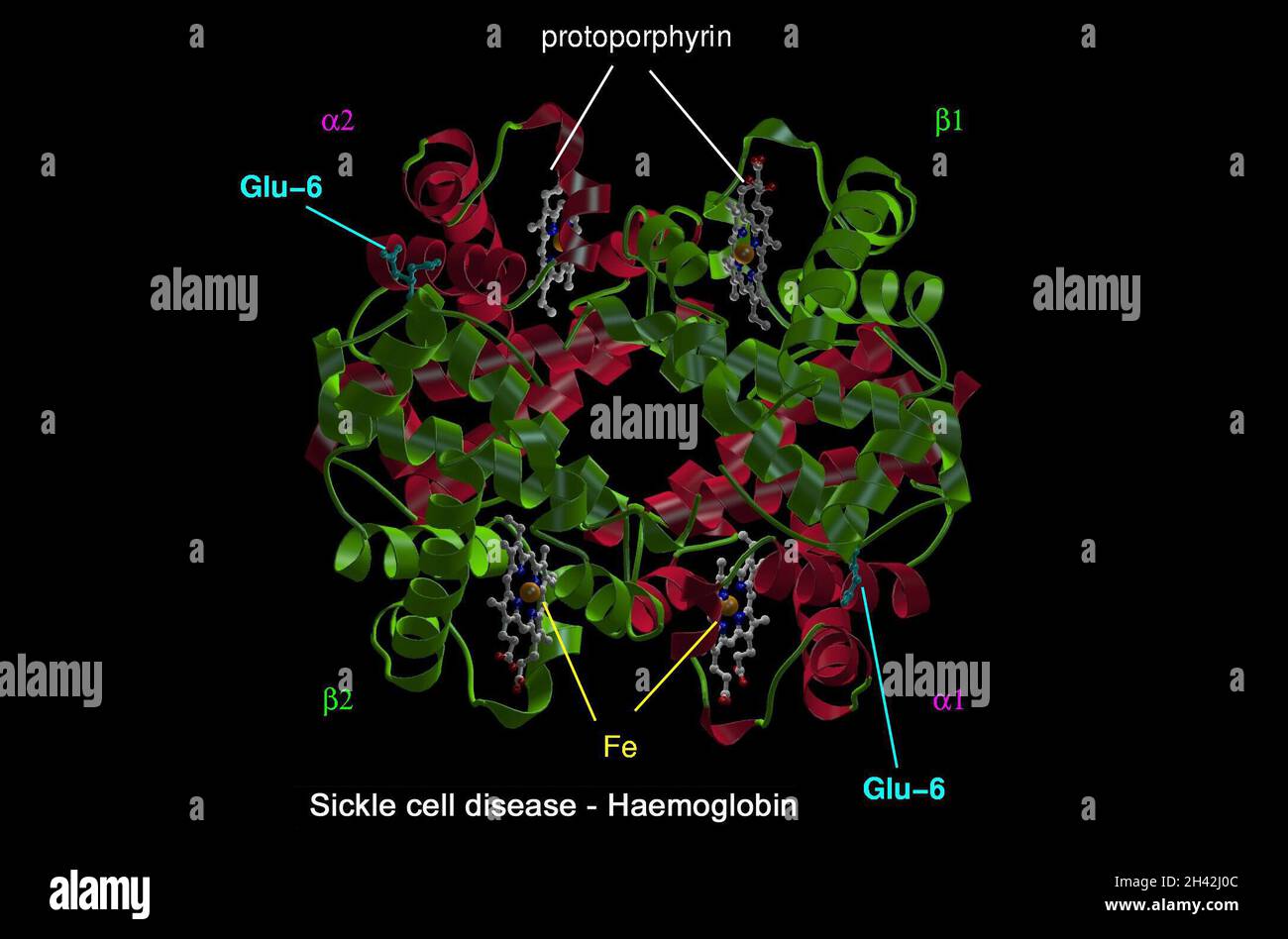 Sickle cell disease - mol. model haemoglobin Stock Photo - Alamy