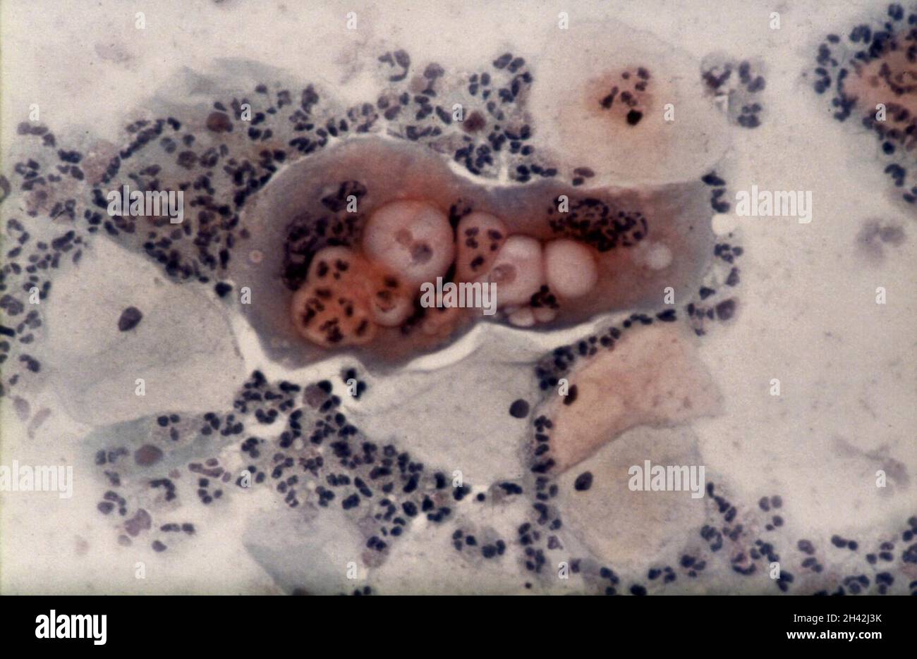 Herpes simplex virus infection Stock Photo - Alamy