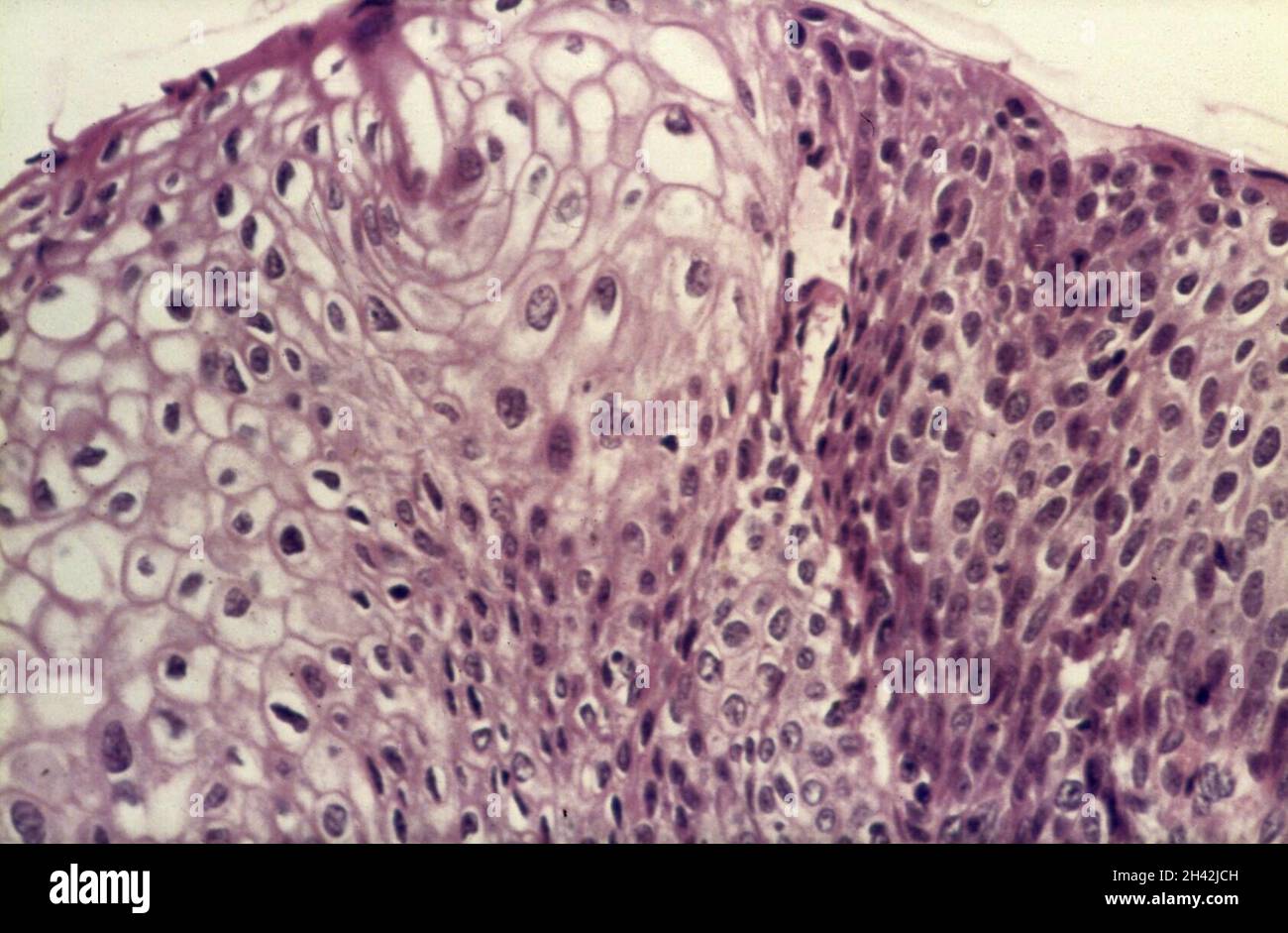 CIN3, cervical section Stock Photo - Alamy