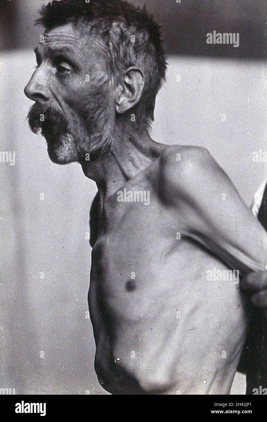 Emaciated old man hi-res stock photography and images - Alamy