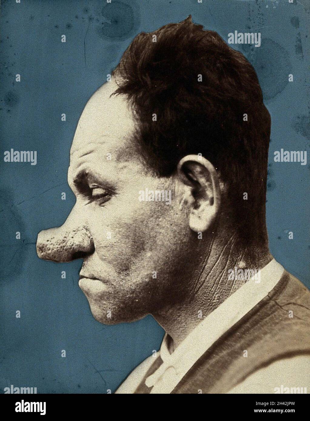 A man with a large, deformed nose diagnosed as caused by hypertrophic ...