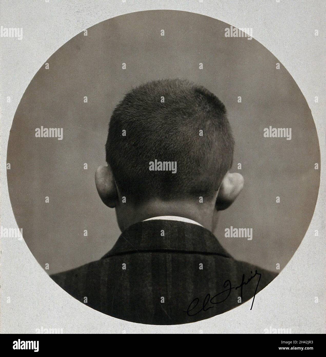 Cosmetic surgery: the back of a man's head, showing his fleshy ears ...