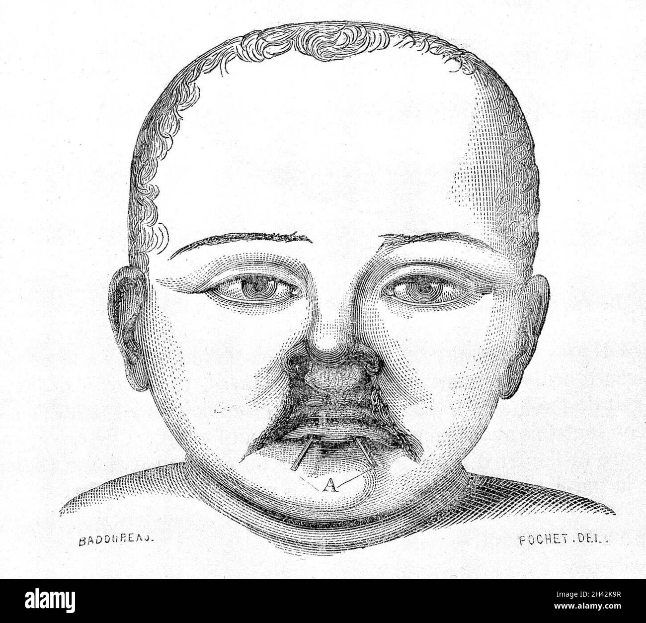 Cleft palate cleft lip hi-res stock photography and images - Alamy