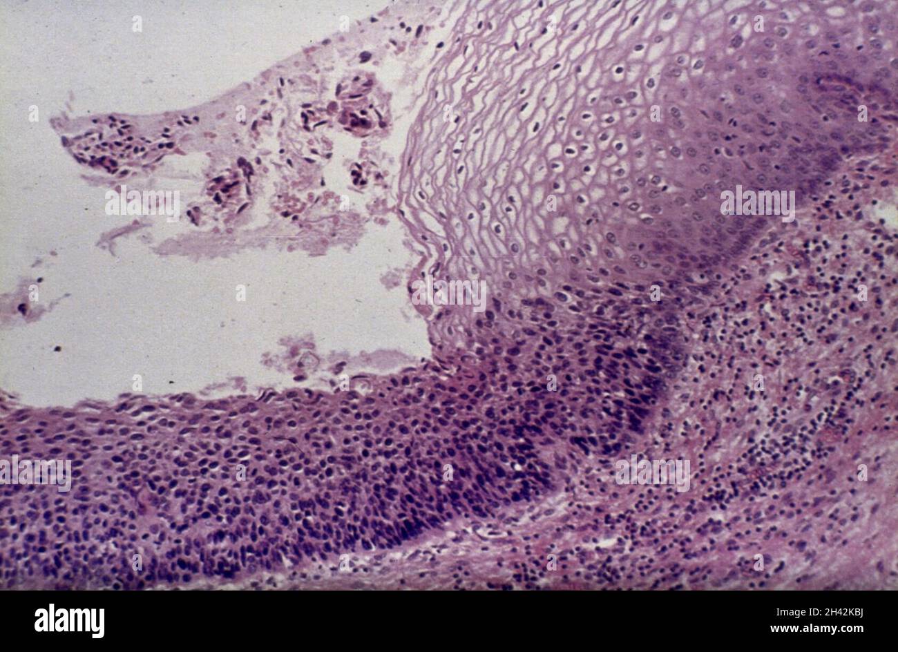 CIN 3, cervical section Stock Photo - Alamy