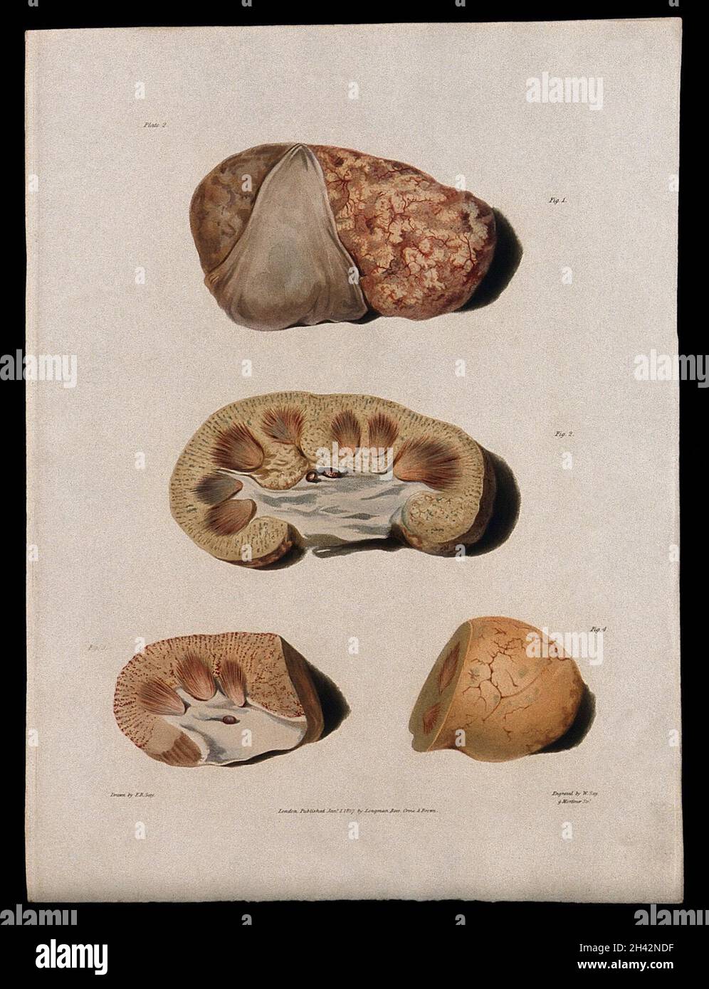 Diseased kidney sections hi-res stock photography and images - Alamy