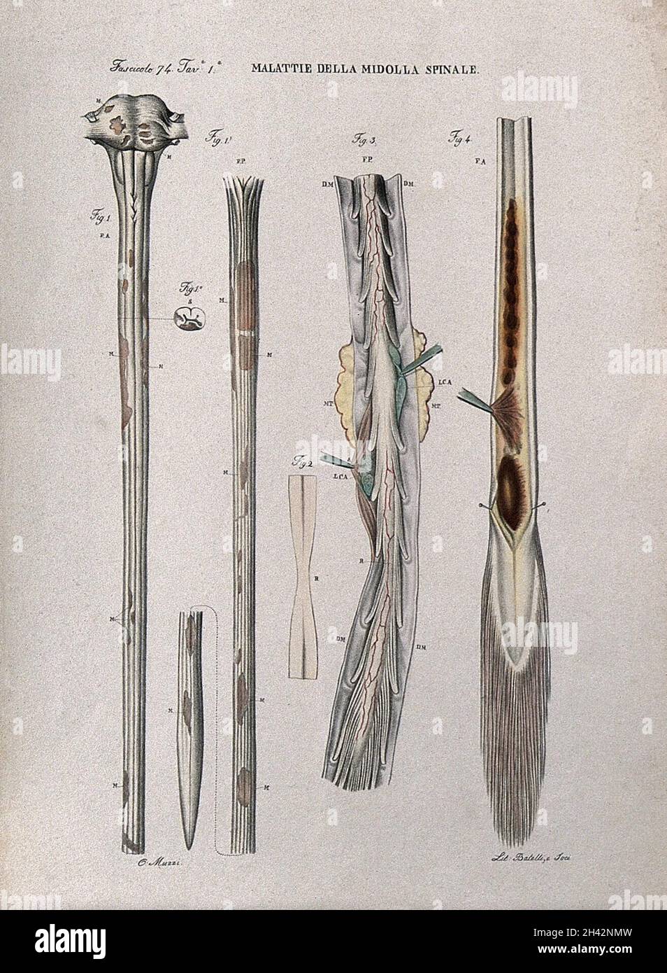 Several sections of diseased spinal cord, numbered for key. Coloured ...