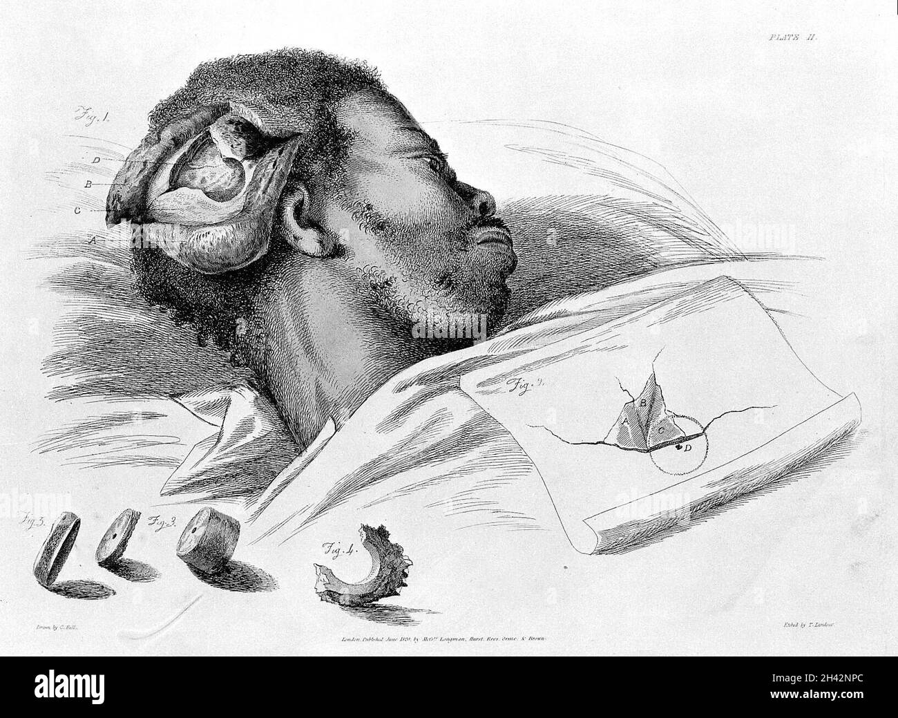 Hole operation Black and White Stock Photos & Images - Alamy