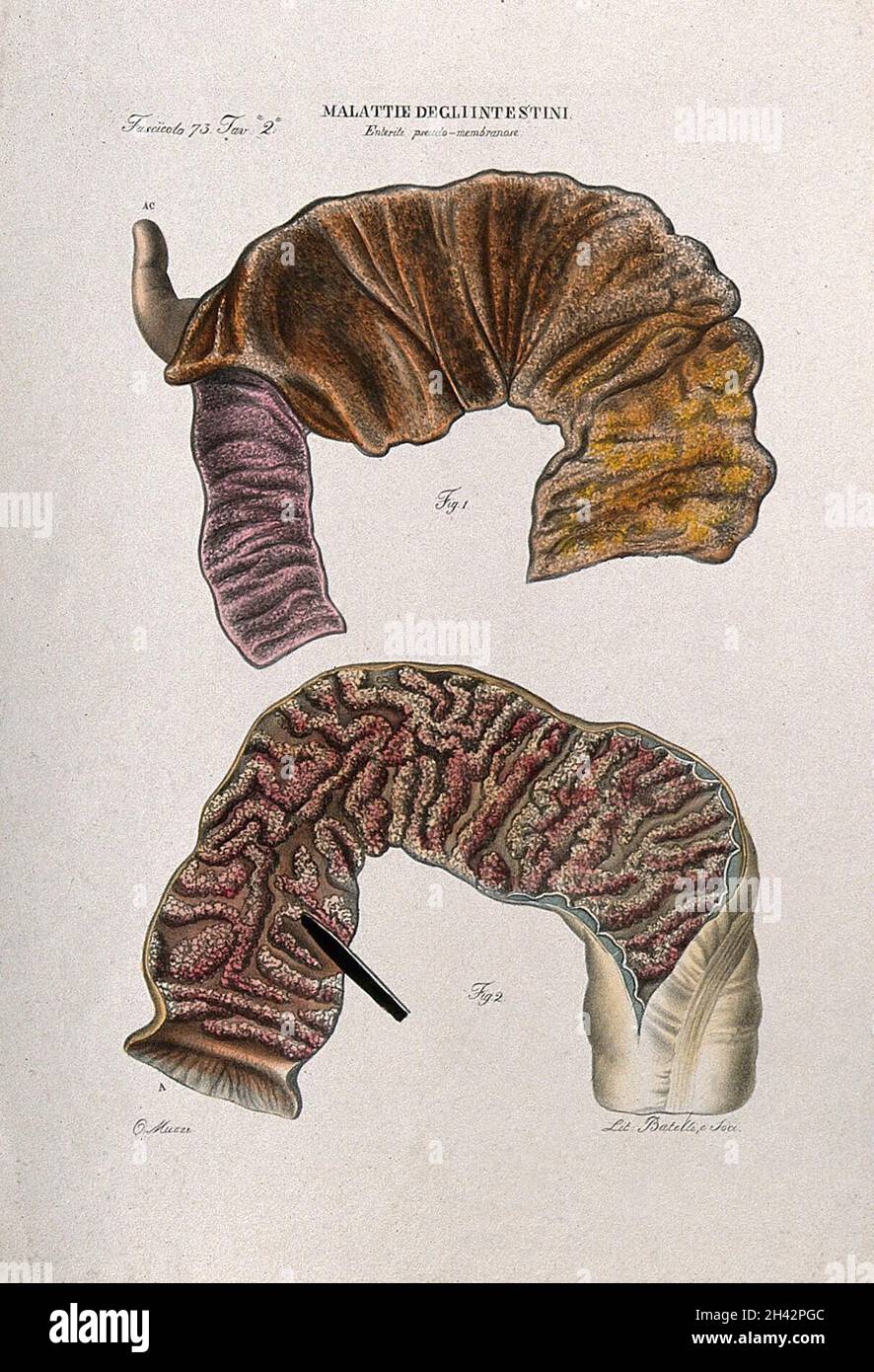 Two sections of diseased intestines, numbered for key. Coloured ...