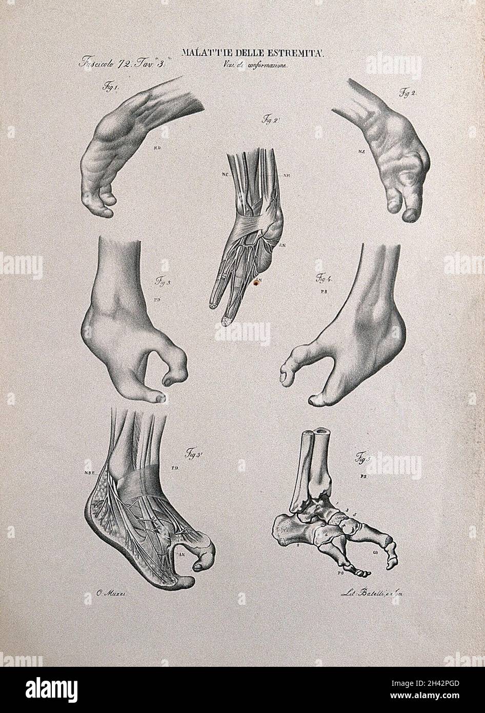 Several examples of deformed feet, each with two pincer-like toes ...