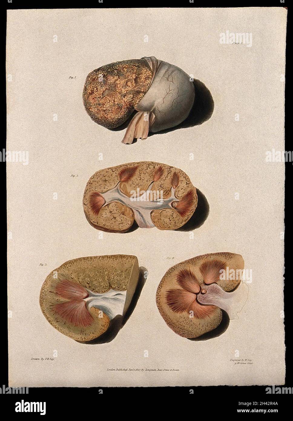 Four sections of diseased kidney. Coloured aquatint by W. Say after F ...