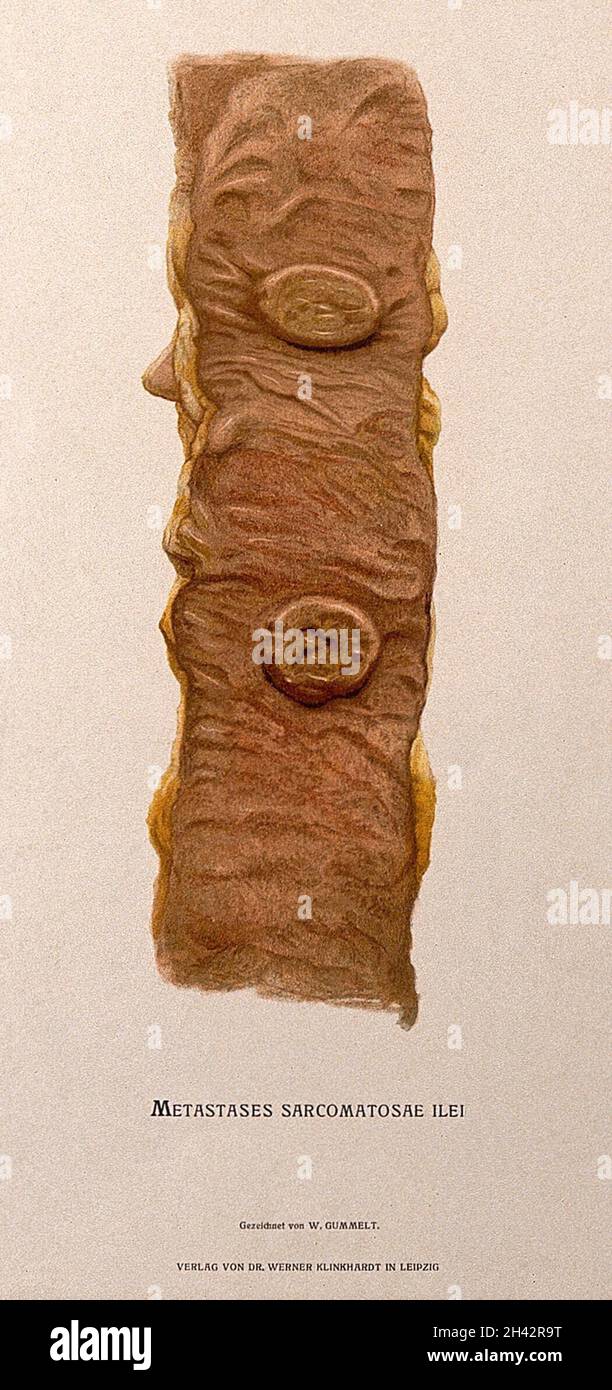 Dissection of a diseased intestine. Chromolithograph by W. Gummelt, ca ...