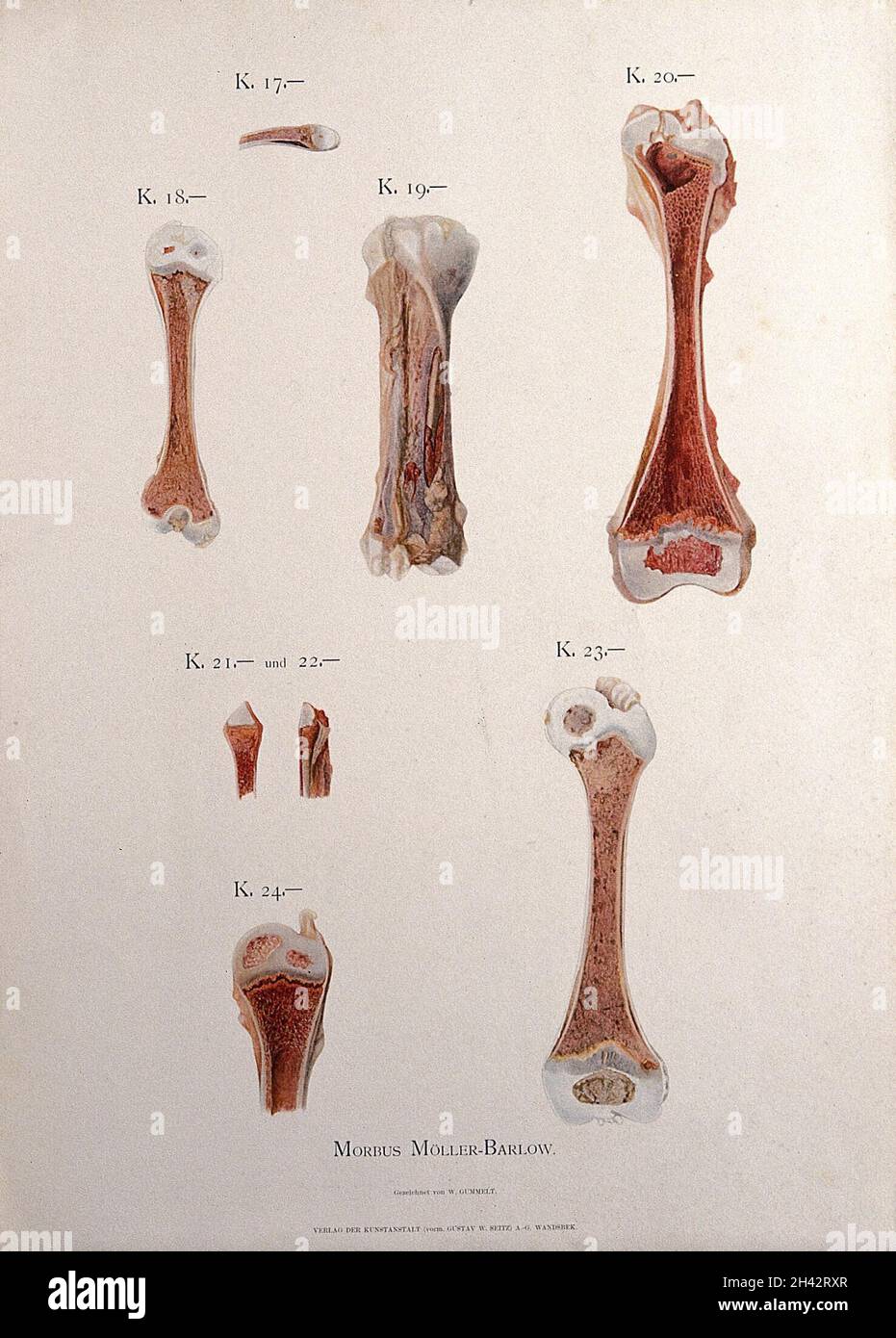 Sections through bones affected by Möller-Barlow disease (hypertrophic ...