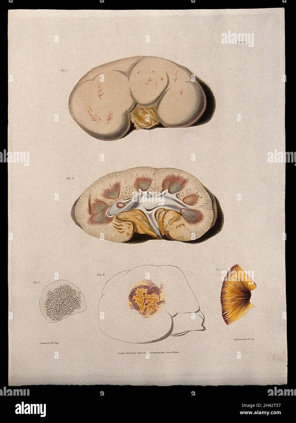 Five sections of diseased kidney. Coloured aquatint by W. Say, 1827 ...