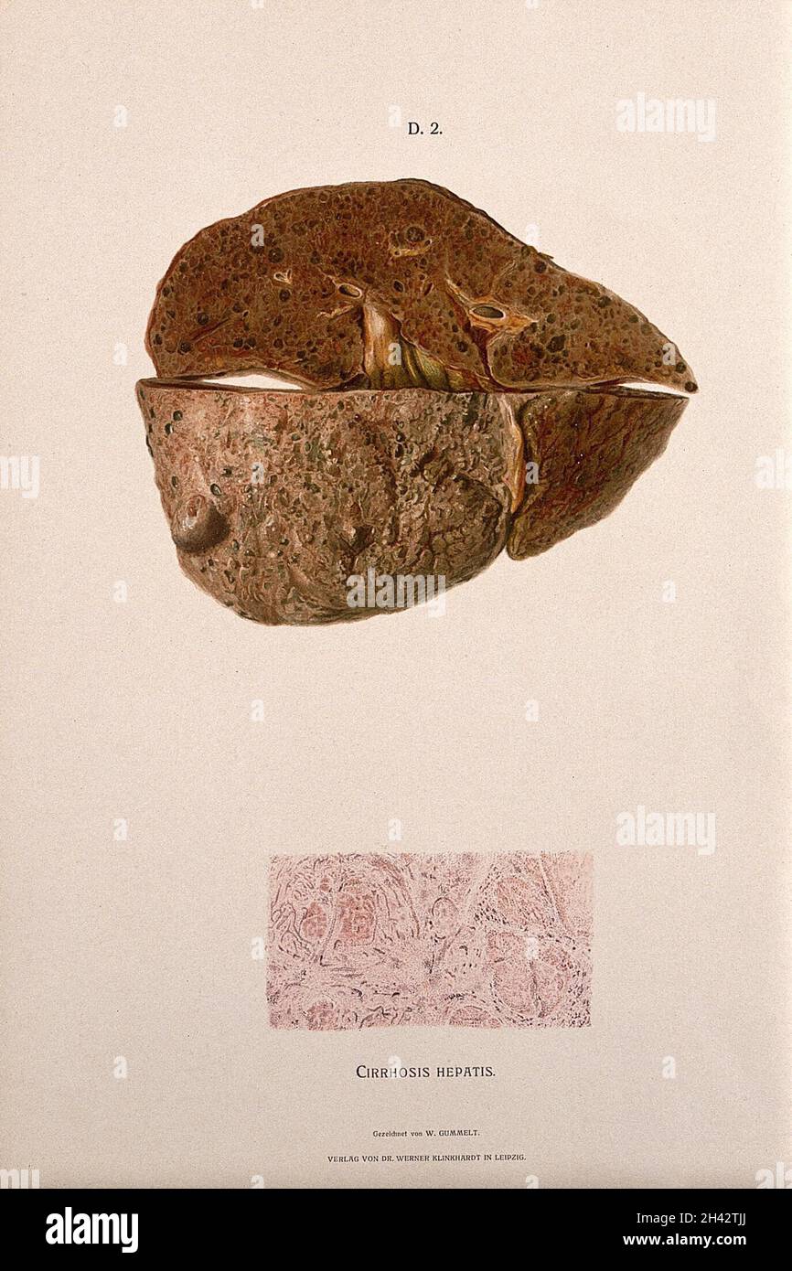 Dissection of a diseased liver, including a section seen under a ...