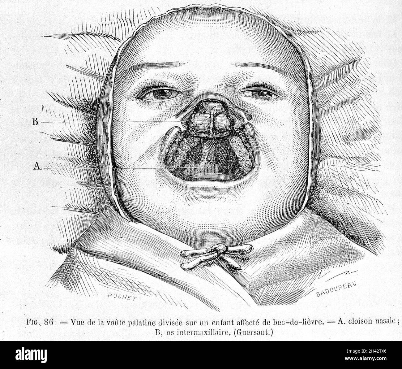 Infant with cleft palate and cleft lip. 19th Century Stock Photo - Alamy
