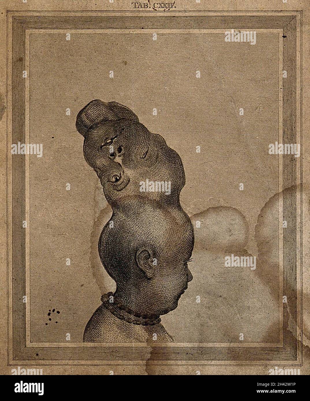 A child with two skulls joined together at the vertex, seen from the ...