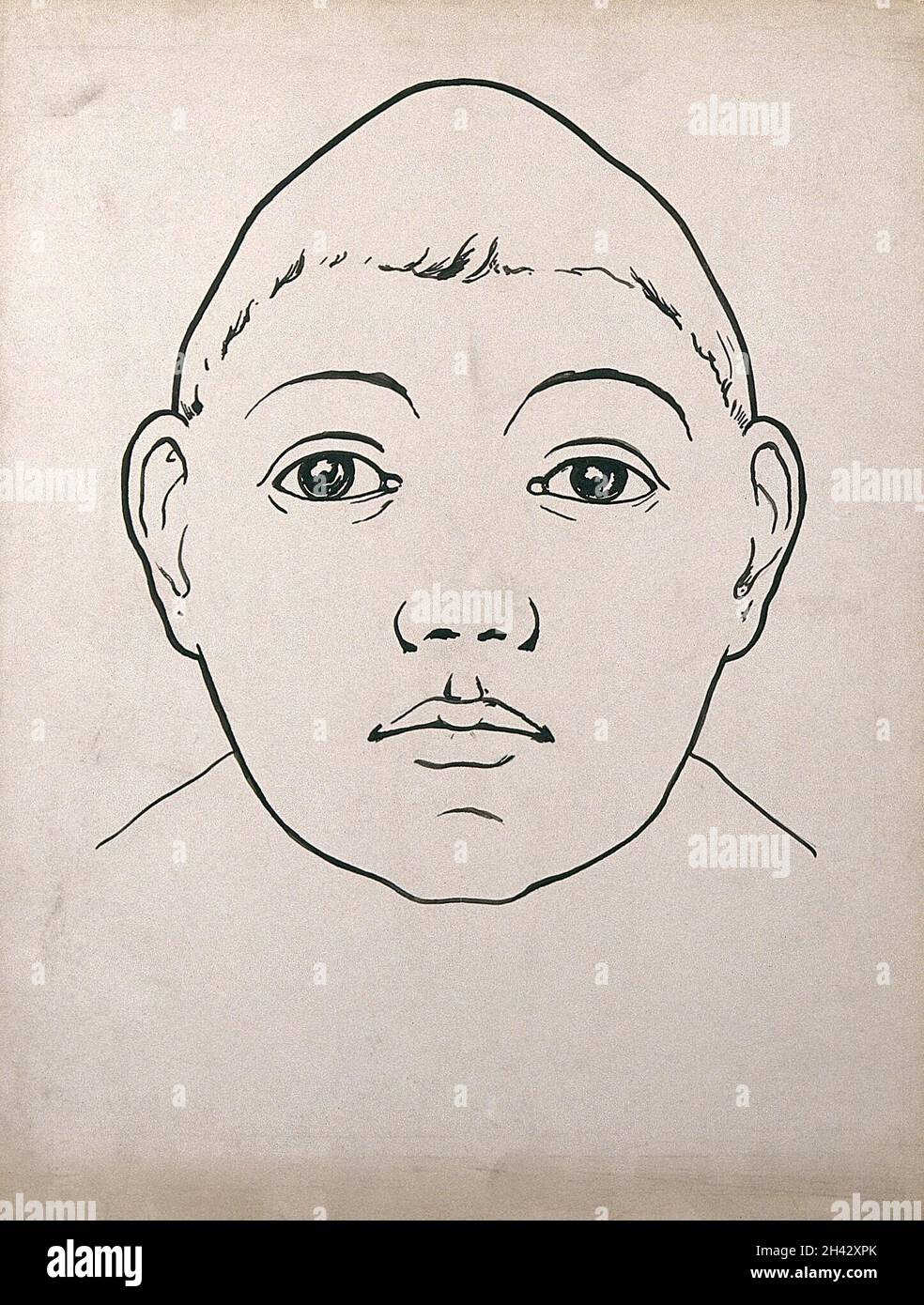 Child's head with large temporal lobes and depressed frontal lobe ...