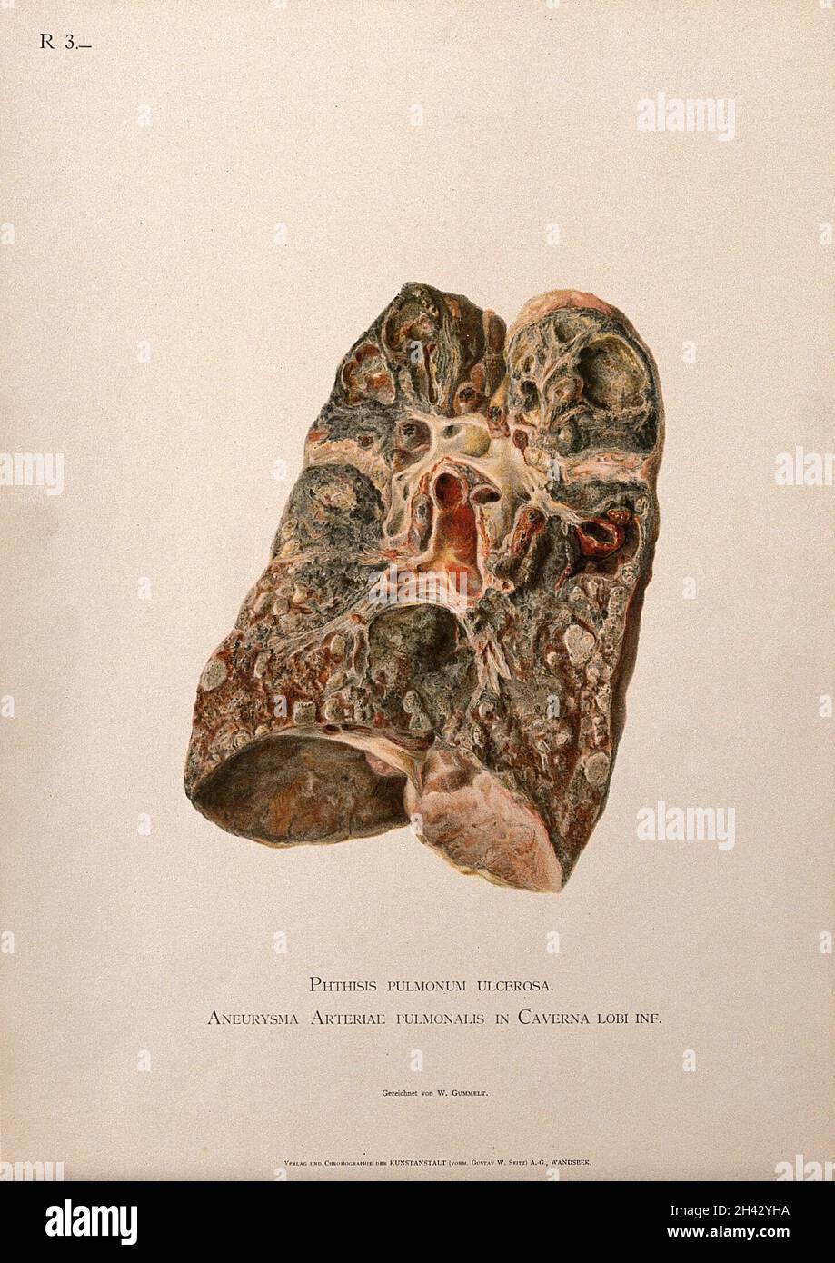 Dissection of a diseased lung, with an aneurysm of the pulmonary artery ...