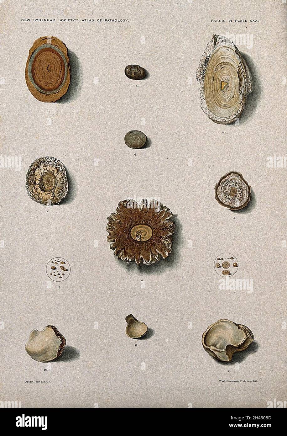 Calculi: twelve examples, including uric acid and lime calculi ...
