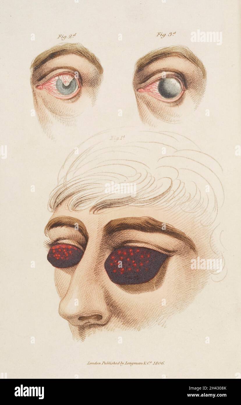 Diagrams of ophthalmia, inflammation of the eye Stock Photo - Alamy