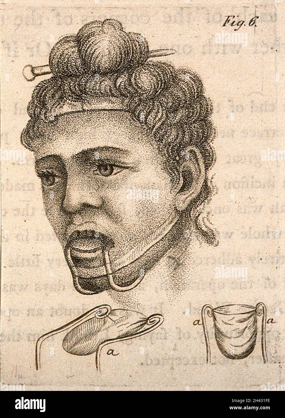 A diagram of a head illustrating a jaw and chin brace. Stipple print by ...