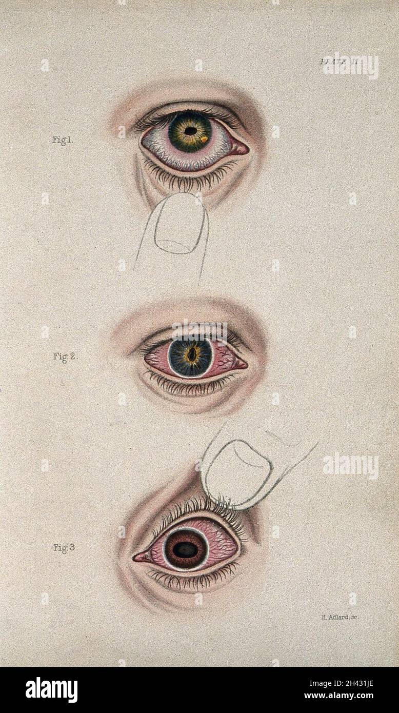 Eye defects hi-res stock photography and images - Alamy