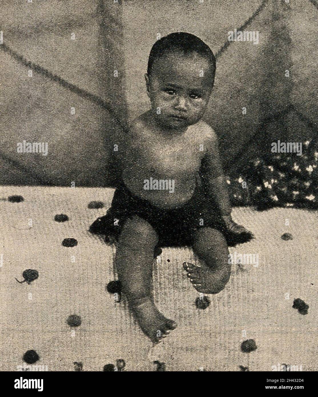 A girl born without an arm. Reproduction, 1905, of a photograph by G ...