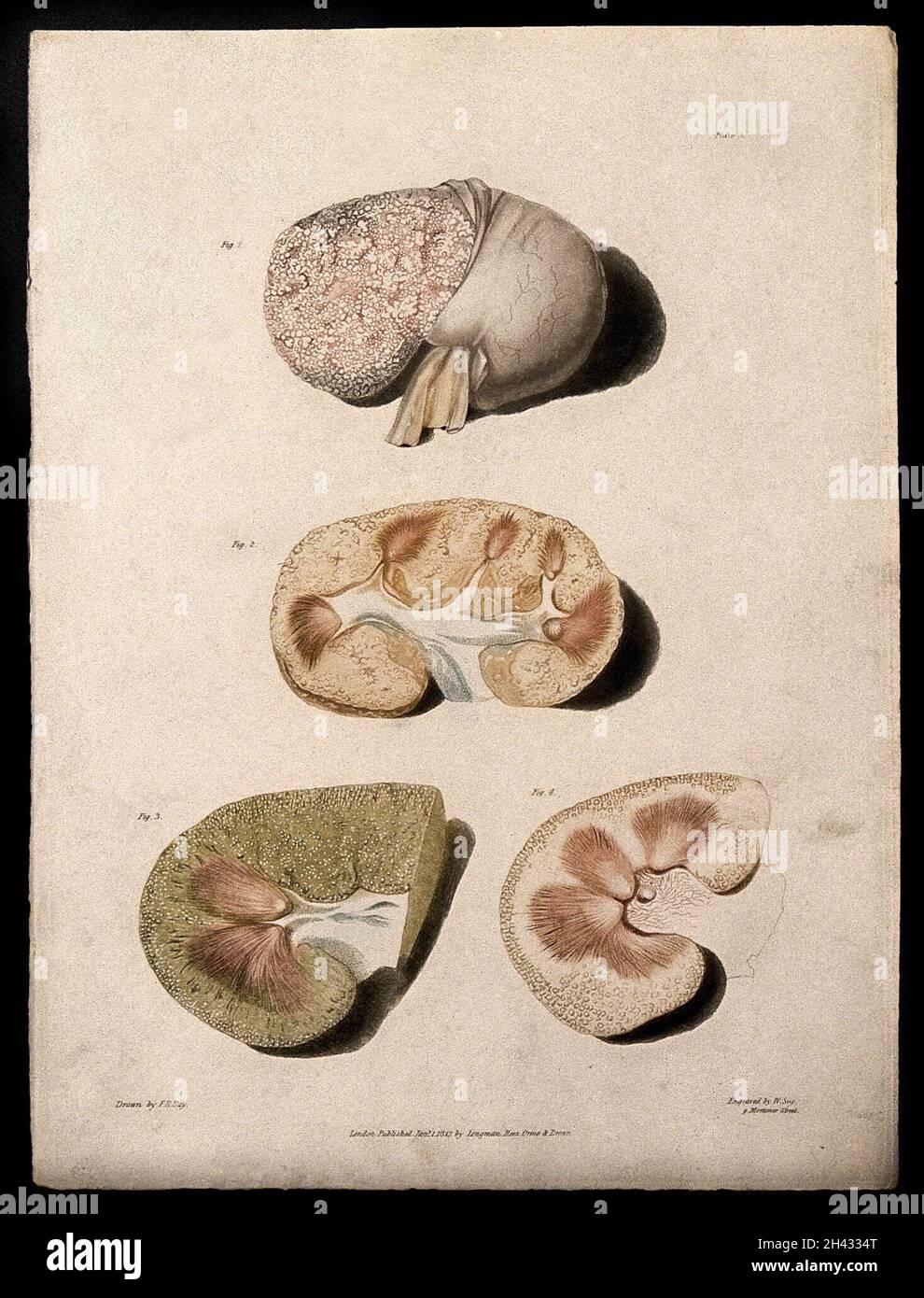 Diseased kidney sections hi-res stock photography and images - Alamy