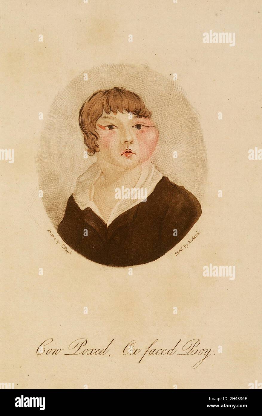 Cow Poxed, Ox Faced Boy - illustration to "Cow-Pox Inoculation No ...
