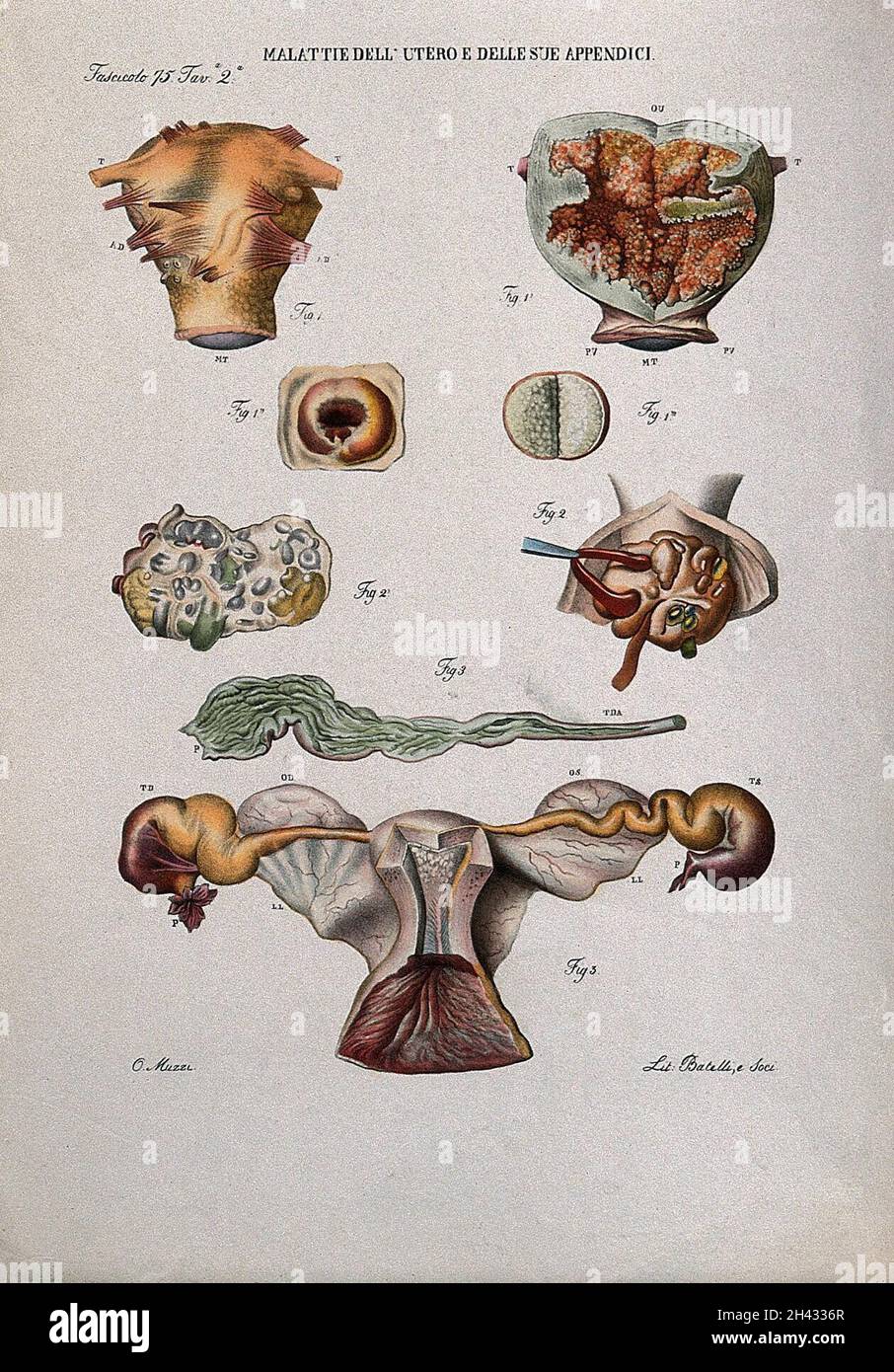 Several sections of diseased uterus and appendix, numbered for key ...