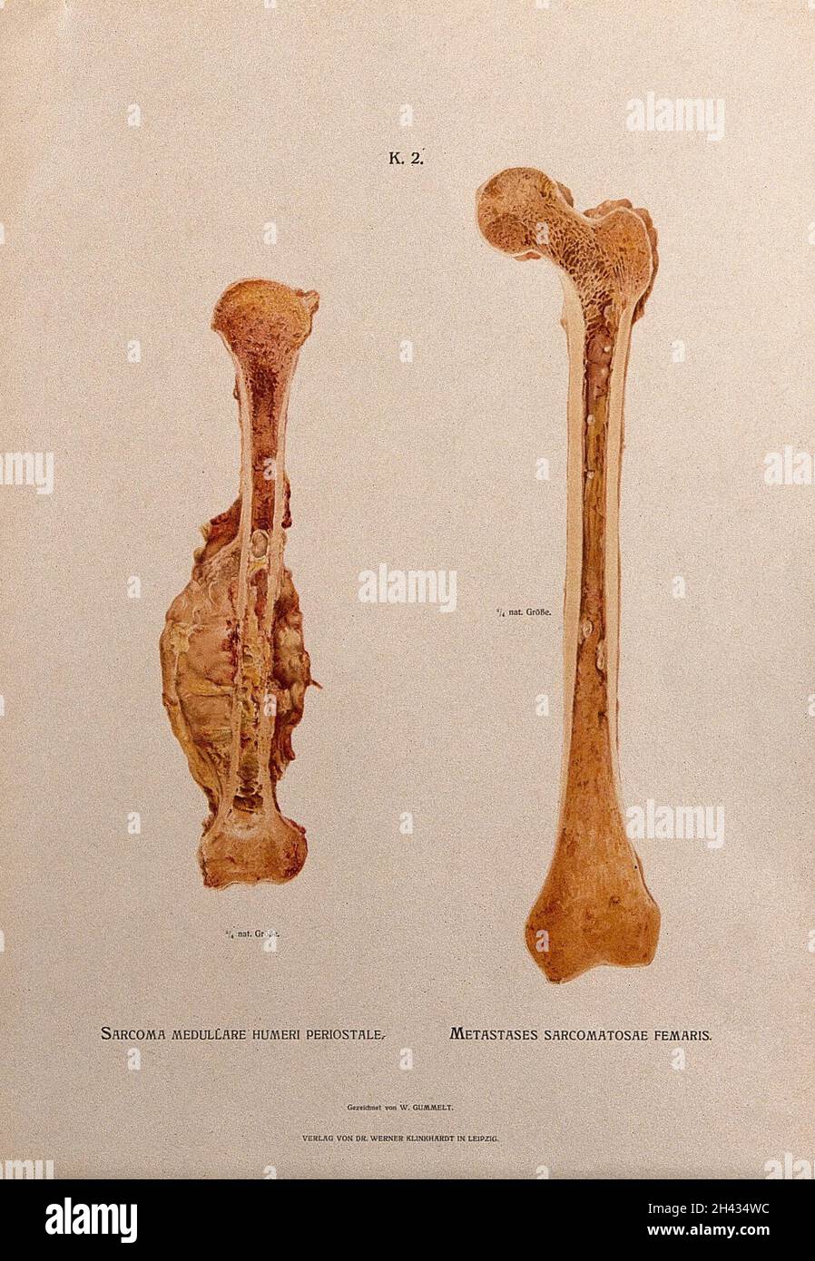 Sections through humerus and femur bones, two figures: the left ...