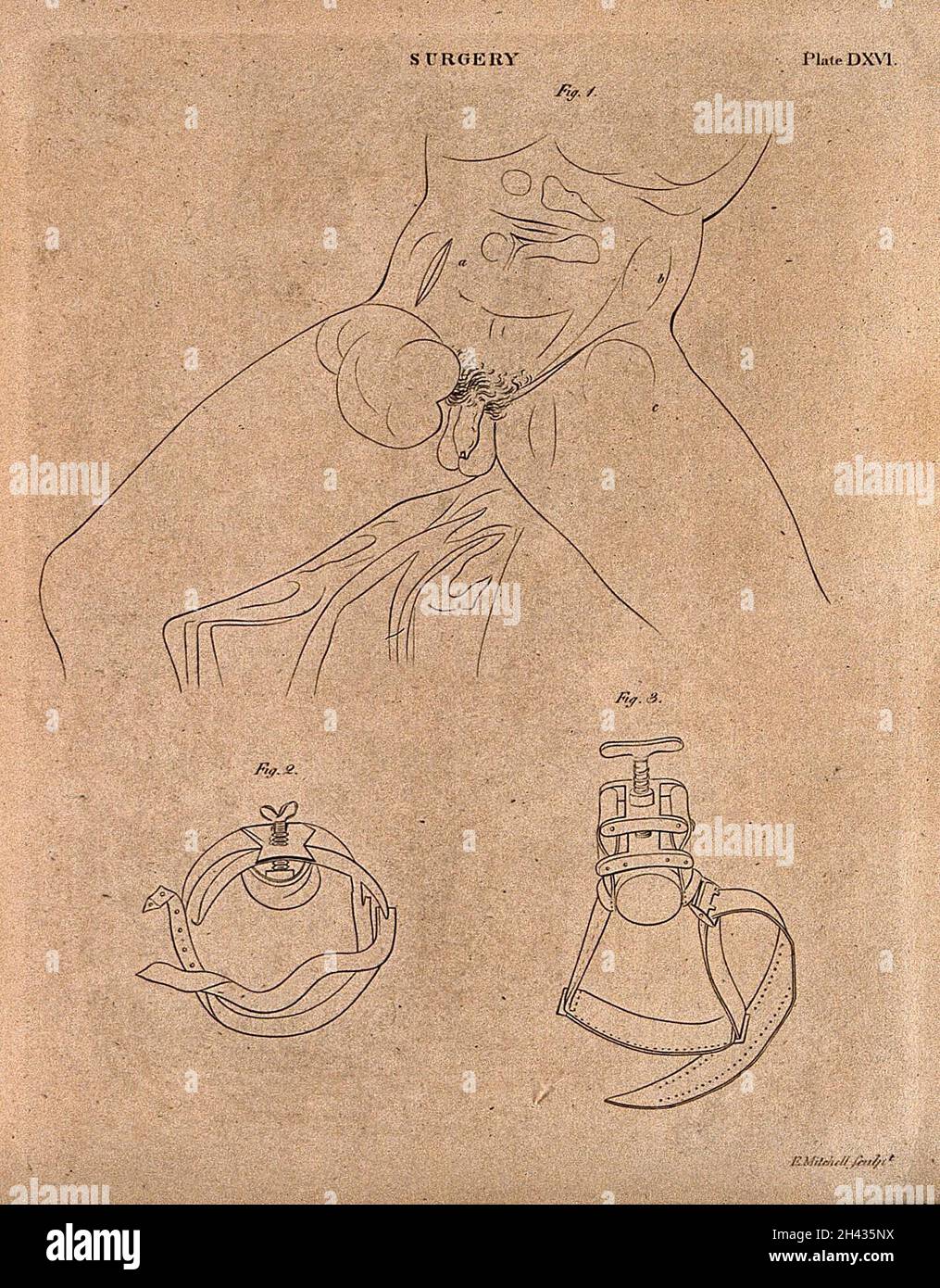 Surgical instruments: trusses or tourniquets for the treatment of ...