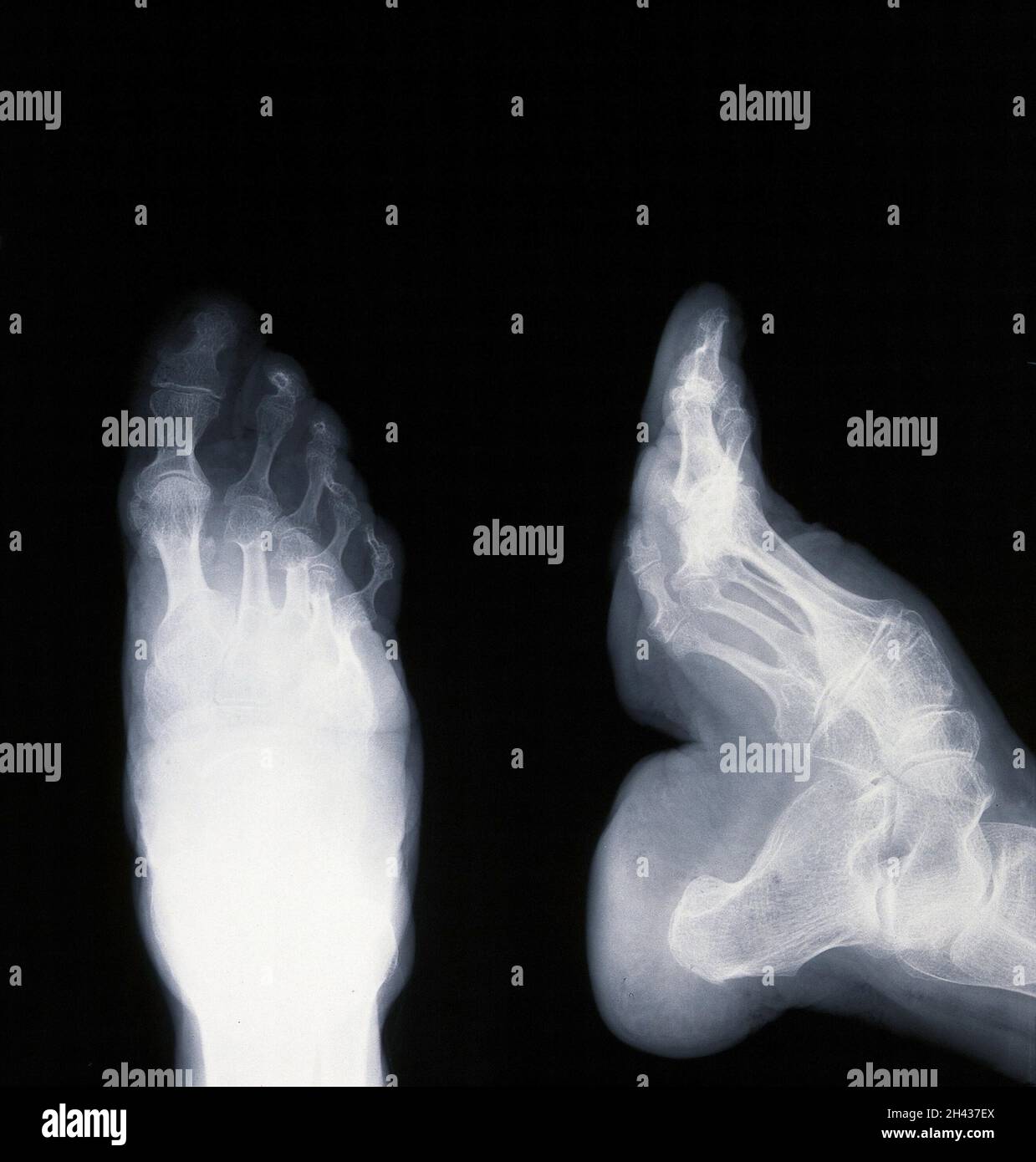 Foot abnormality hi-res stock photography and images - Alamy